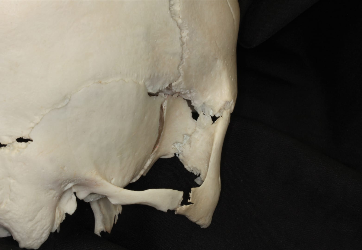 Posterior View of the Temporal Fossa and Pterion | Neuroanatomy | The ...