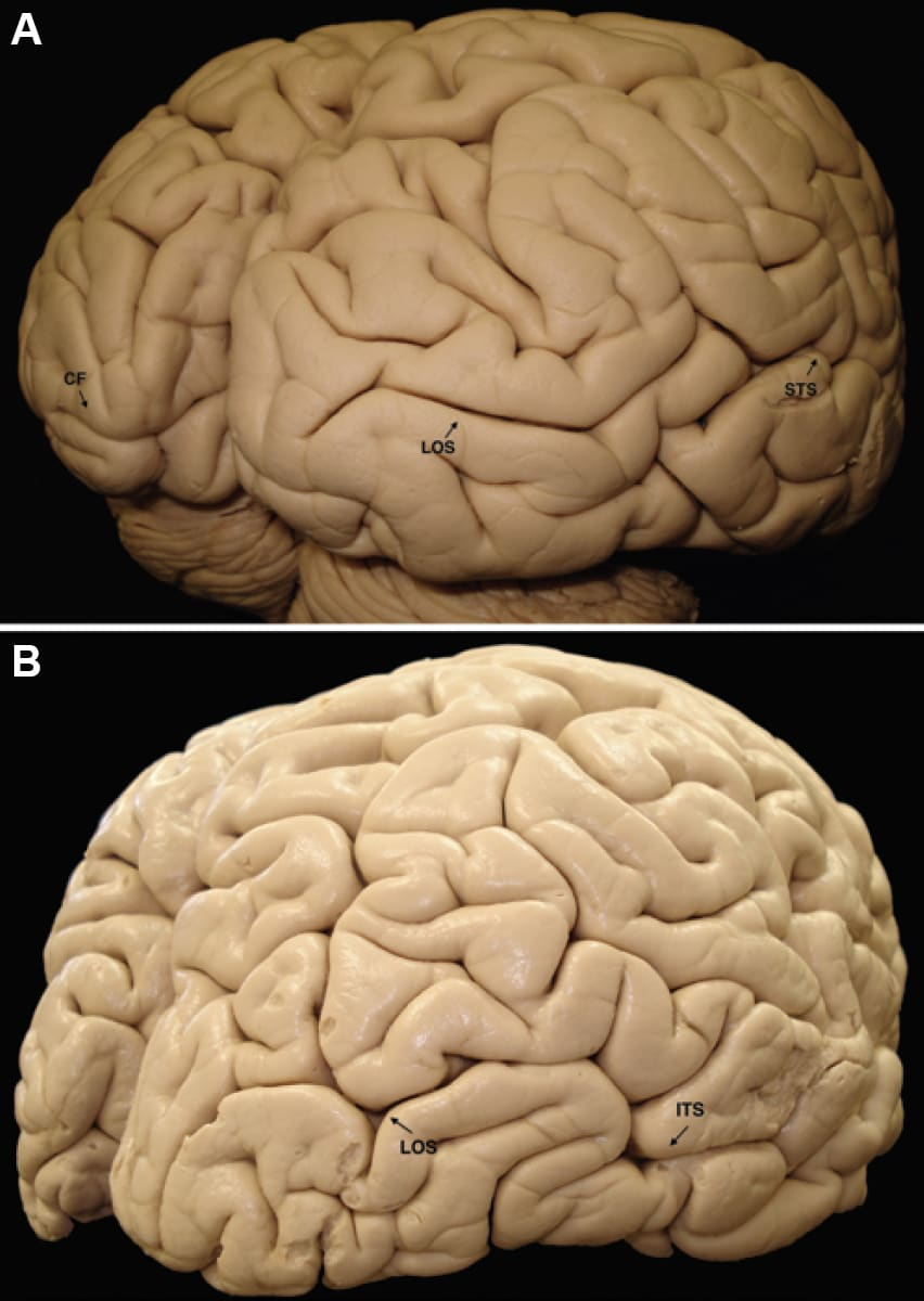 Posterolateral View of the Right Hemisphere | Neuroanatomy | The ...