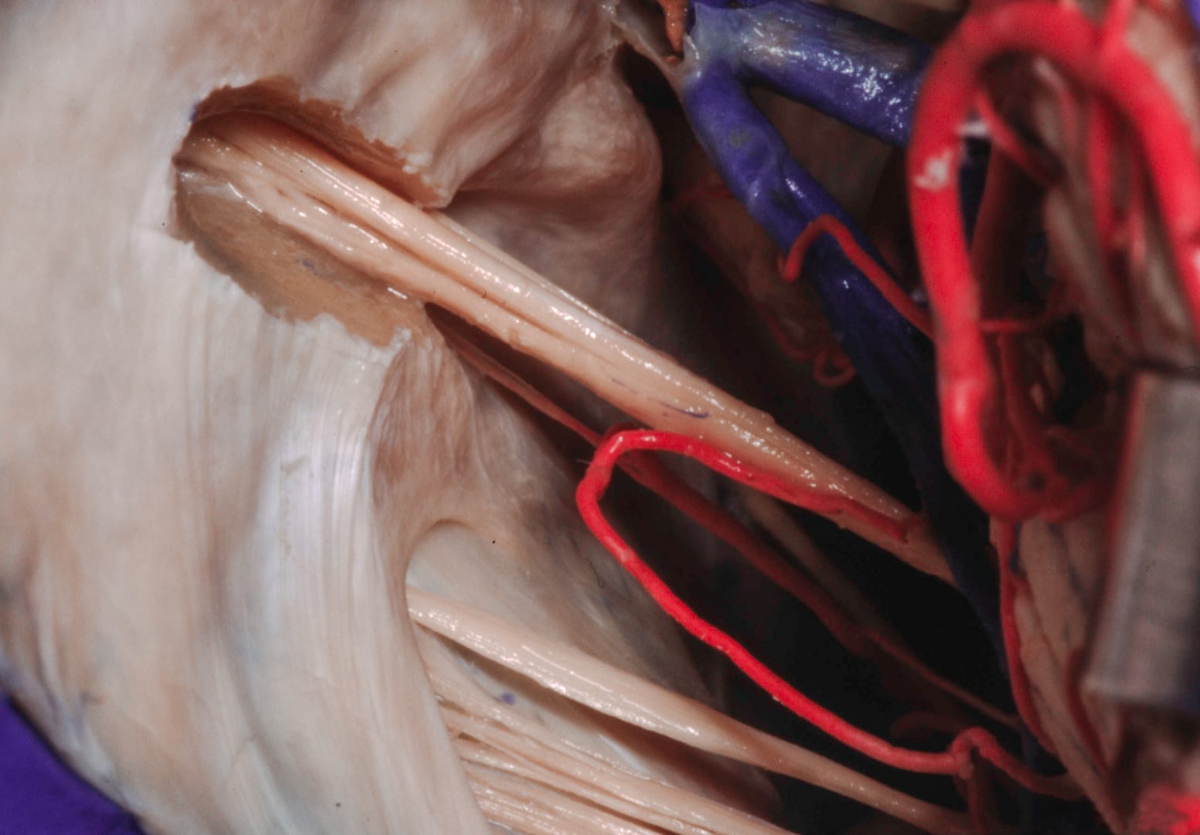 Posterosuperior View of Left Cerebellopontine Angle | Neuroanatomy ...