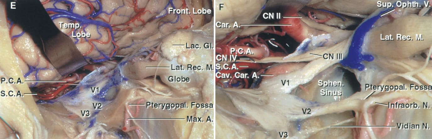 Preauricular Subtemporal-Infratemporal Fossa Approach | Neuroanatomy ...