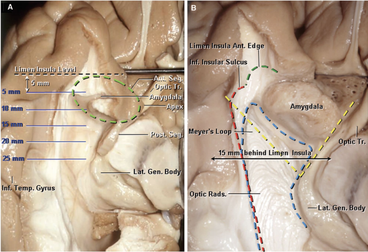 Relationship of Meyer’s Loop to the Mediobasal Temporal Structures ...