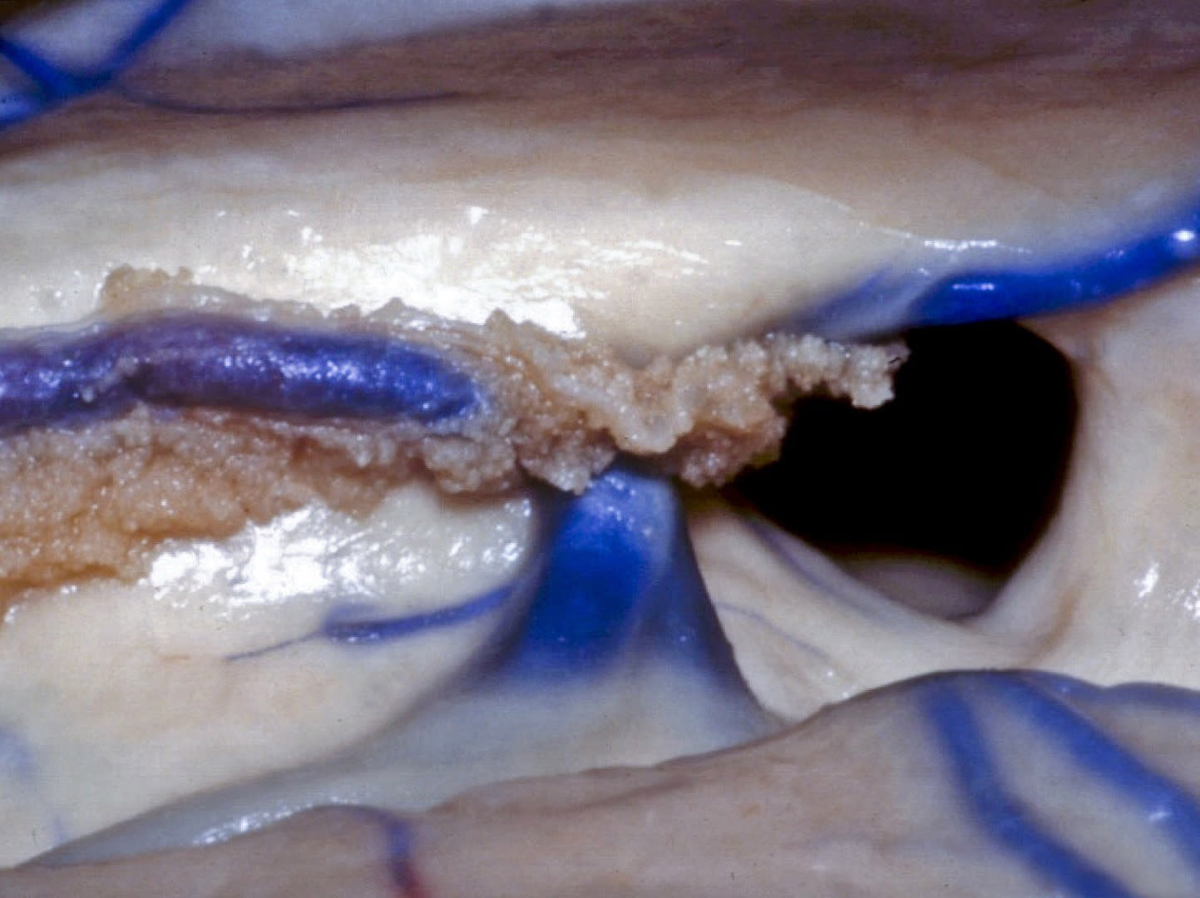 Right Interventricular Foramen of Monro | Neuroanatomy | The ...