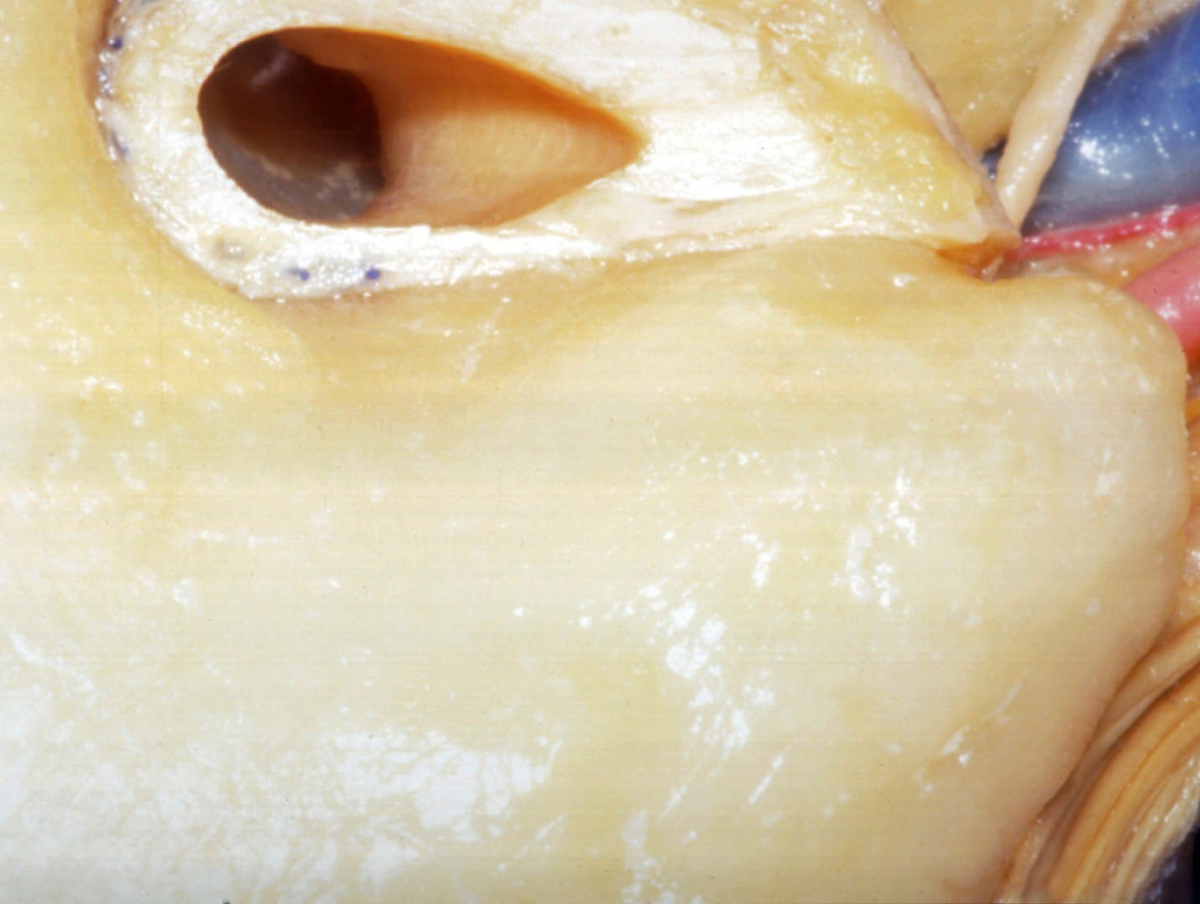 Right Lateral View of Mastoid Process and External Auditory Canal ...