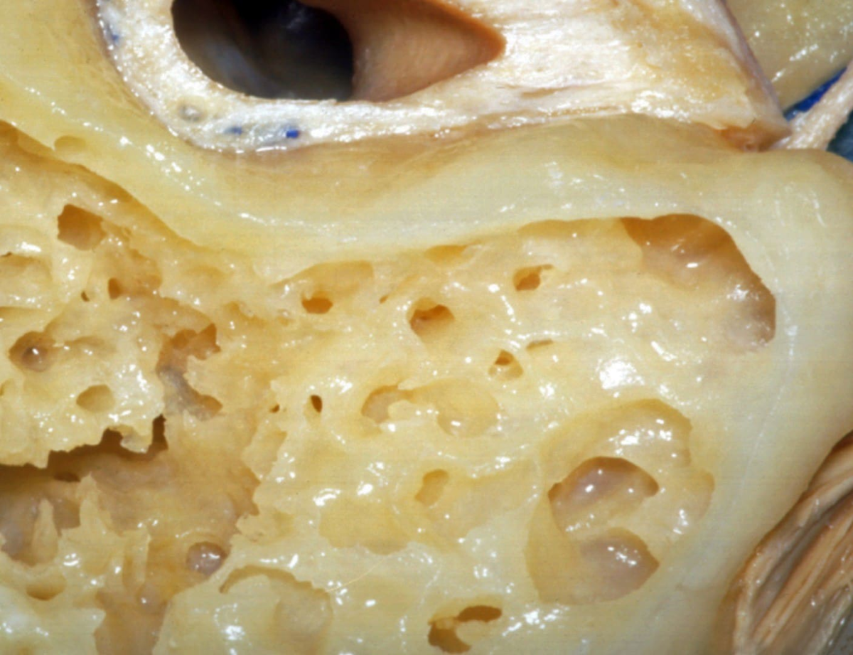 Right Lateral View of Mastoid Process, Mastoid Air Cells, and External ...