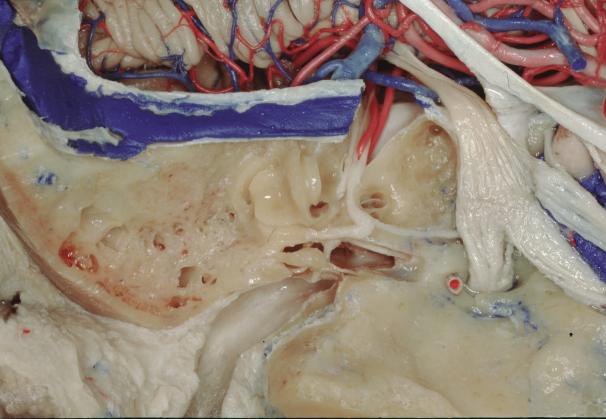 Right Lateral View of Middle Fossa and Auditory Complex Following ...