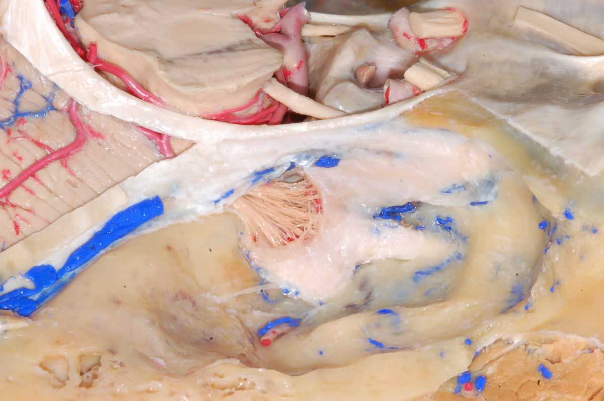 Right Lateral View of Tentorial Notch and Adjacent Structures ...