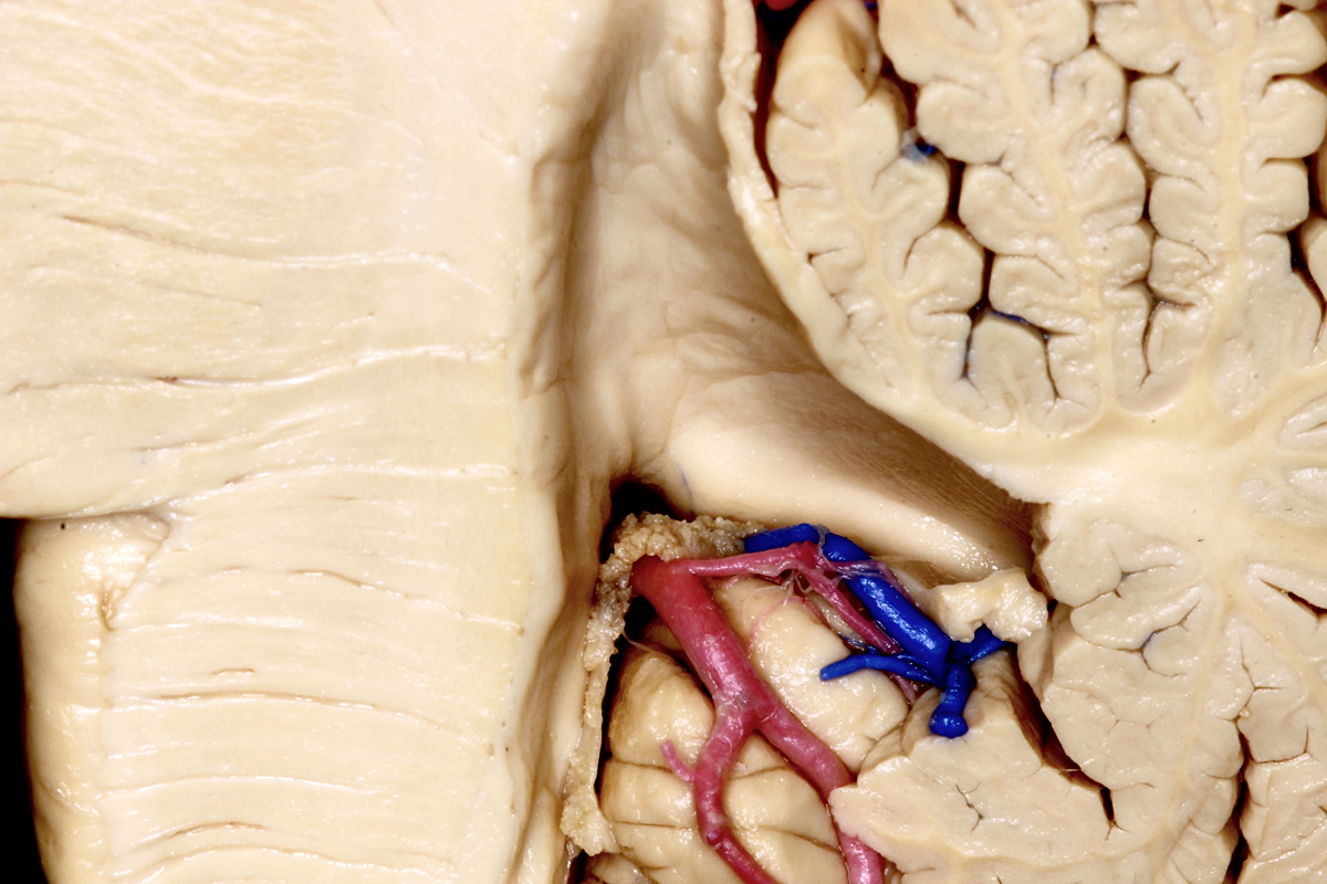 Sagittal View of Fourth Ventricle | Neuroanatomy | The Neurosurgical Atlas