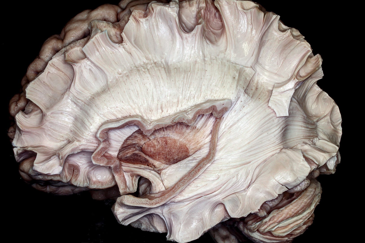 Sagittal View of the Basal Ganglia and Cerebral White Matter Tracts | Neuroanatomy | The ...