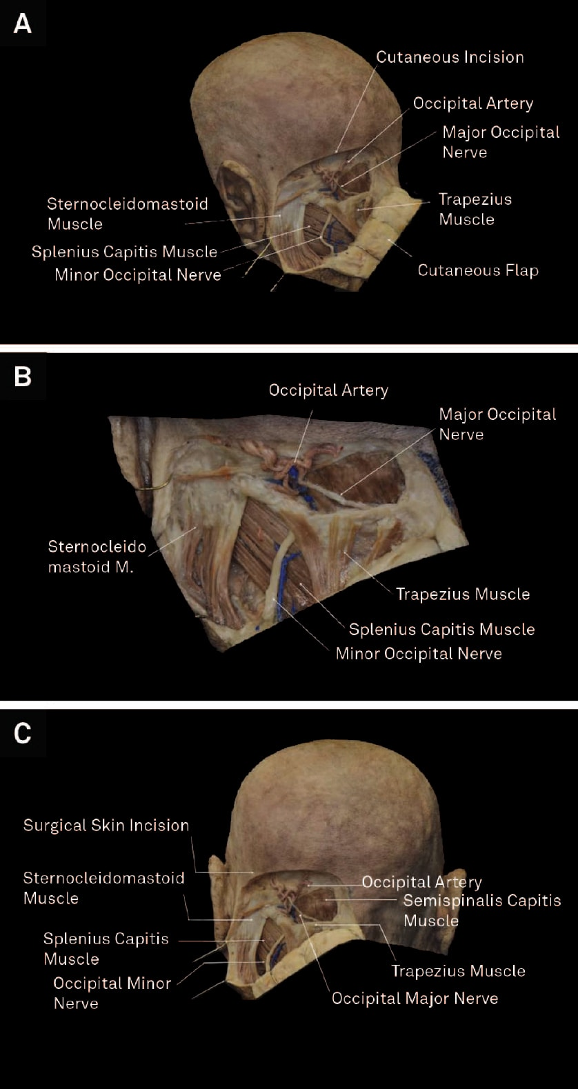 Steps in Far-Lateral Craniotomy, Following Cutaneous Incision ...