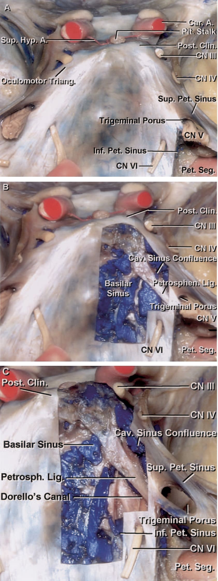 Stepwise Dissection of the Posterior Wall of the Cavernous Sinus ...
