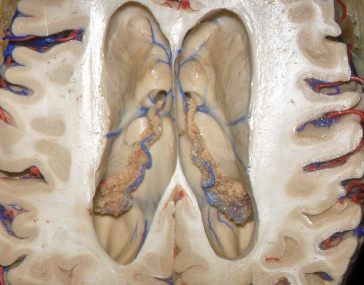Superior Perspective of the Lateral Ventricles | Neuroanatomy | The ...