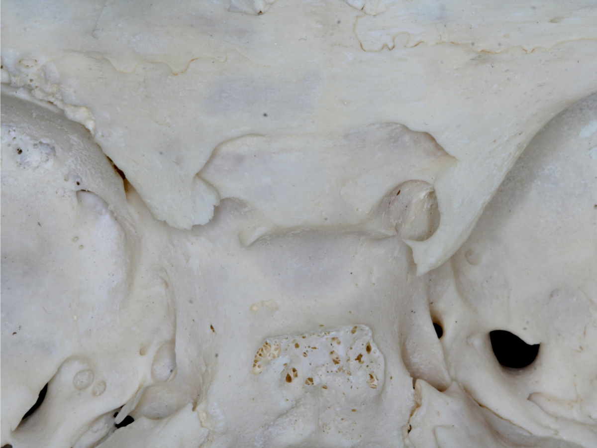 Superior View of Sphenoid Bone | Neuroanatomy | The Neurosurgical Atlas