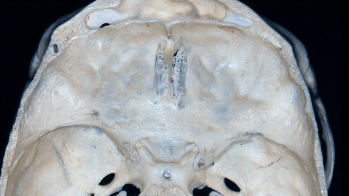 Superior View of the Bony Anterior and Middle Cranial Fossae ...