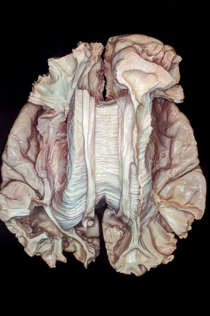 Superior View of the Cingulum and Corpus Callosum | Neuroanatomy | The ...