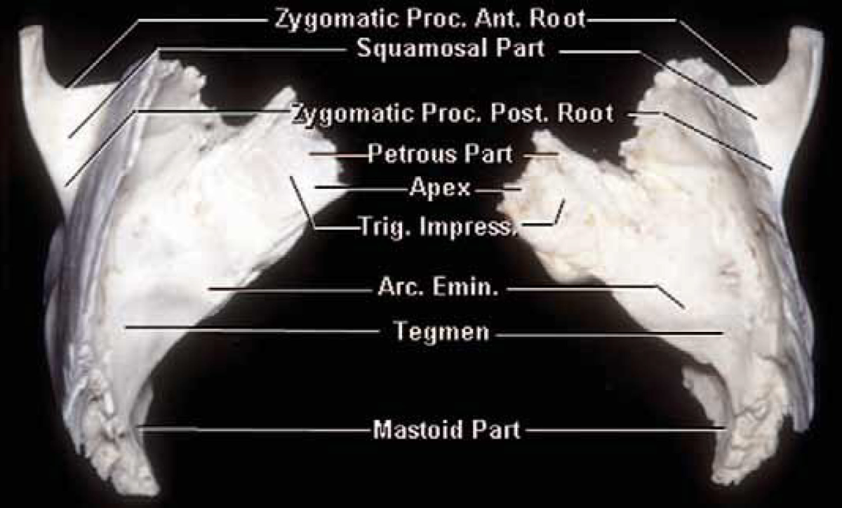 Superior View of the Left and Right Temporal Bones | Neuroanatomy | The ...