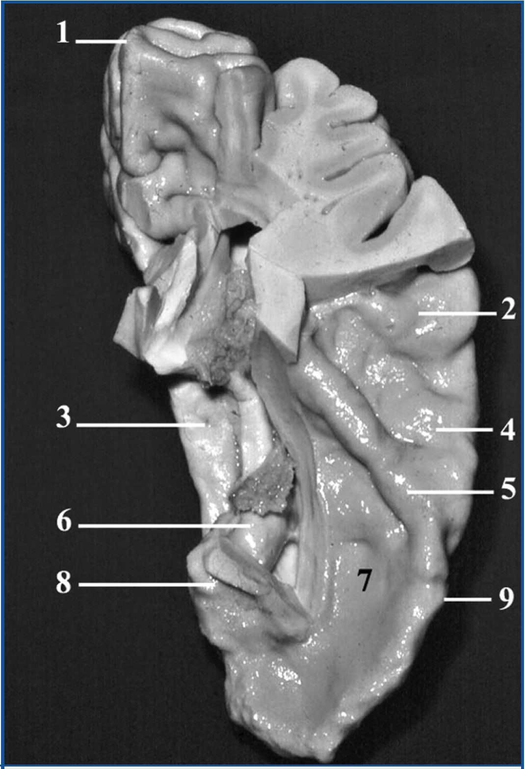 Superior View of the Left Temporal Lobe | Neuroanatomy | The ...