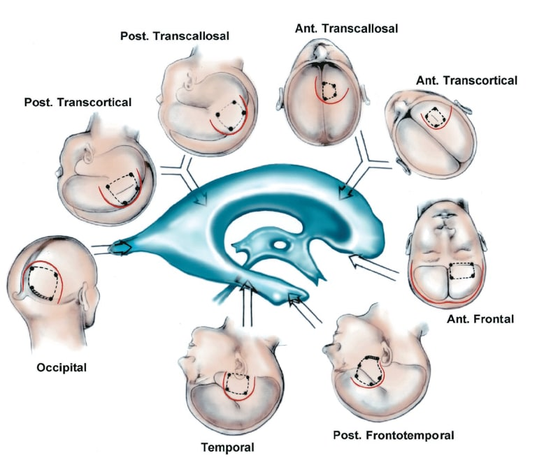 Lateral Ventricle Anatomy