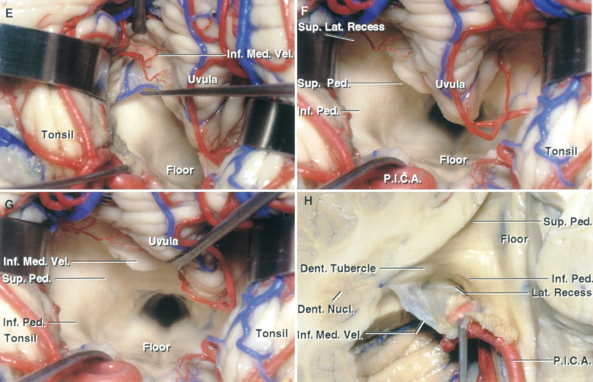 Telovelar Approach to the Fourth Ventricle | Neuroanatomy | The ...