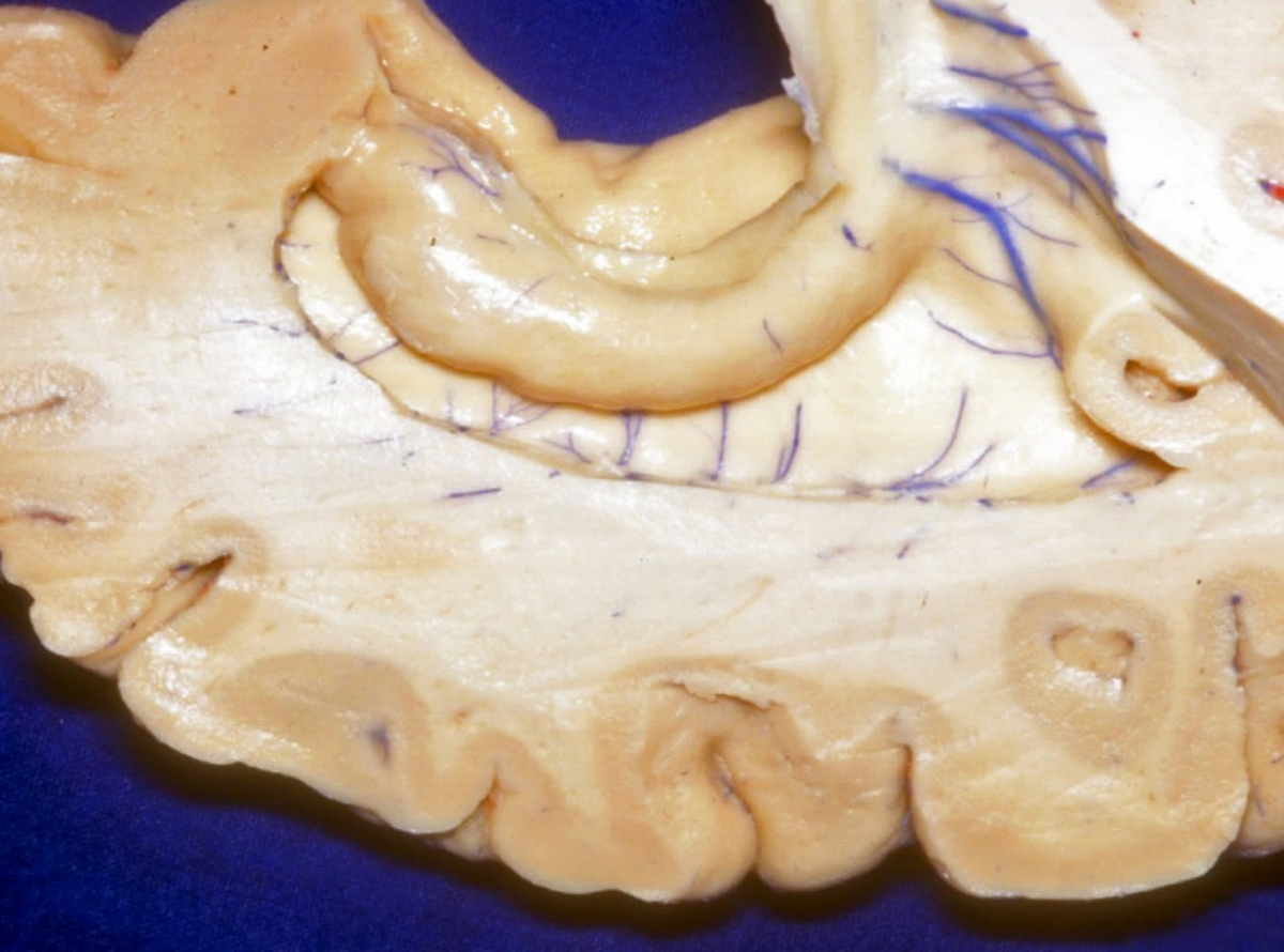 Temporal Horn of the Lateral Ventricle and Parahippocampal Region ...