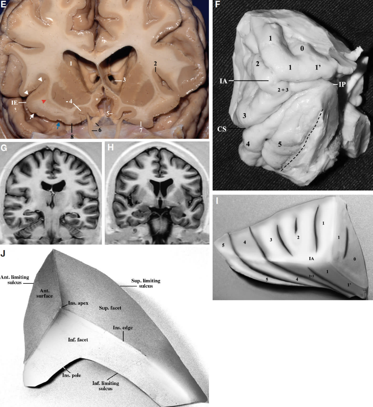 The Insular Region | Neuroanatomy | The Neurosurgical Atlas