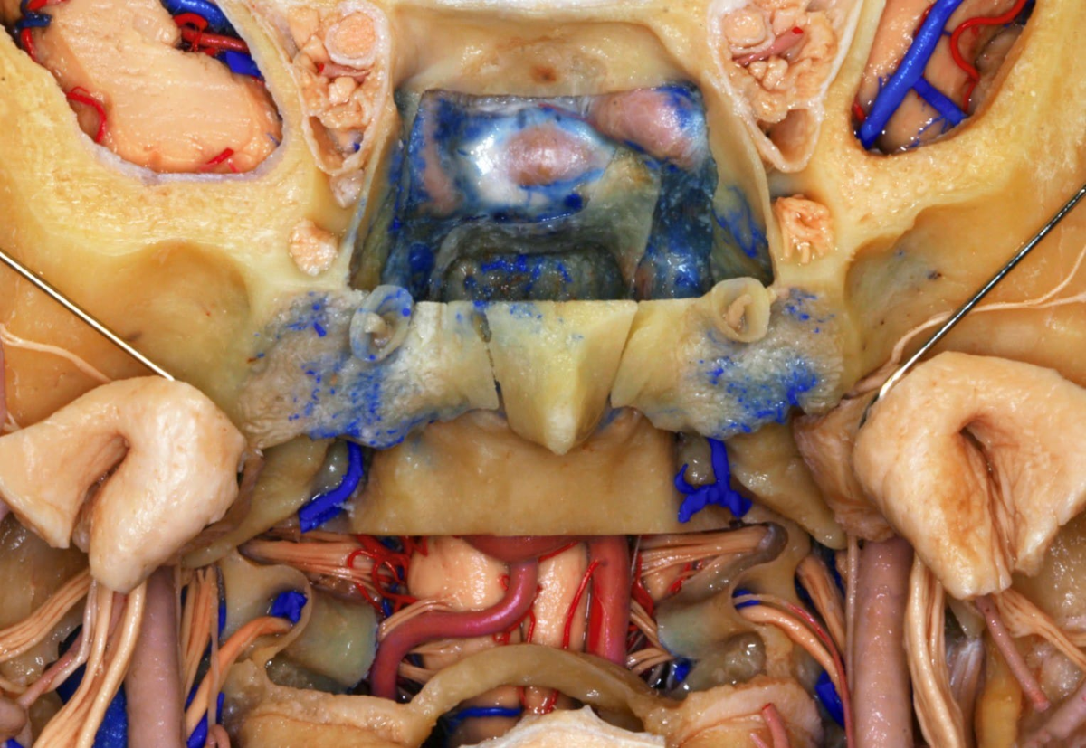 Transfacial View of Clival and Sphenoidal Region | Neuroanatomy | The ...