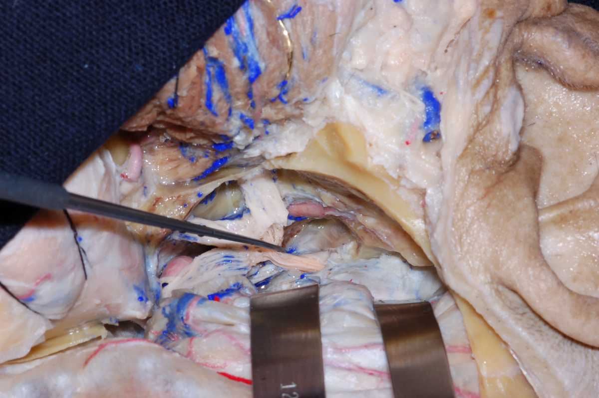 Transtemporal Craniotomy and Exposure of the Right Trigeminal Nerve ...