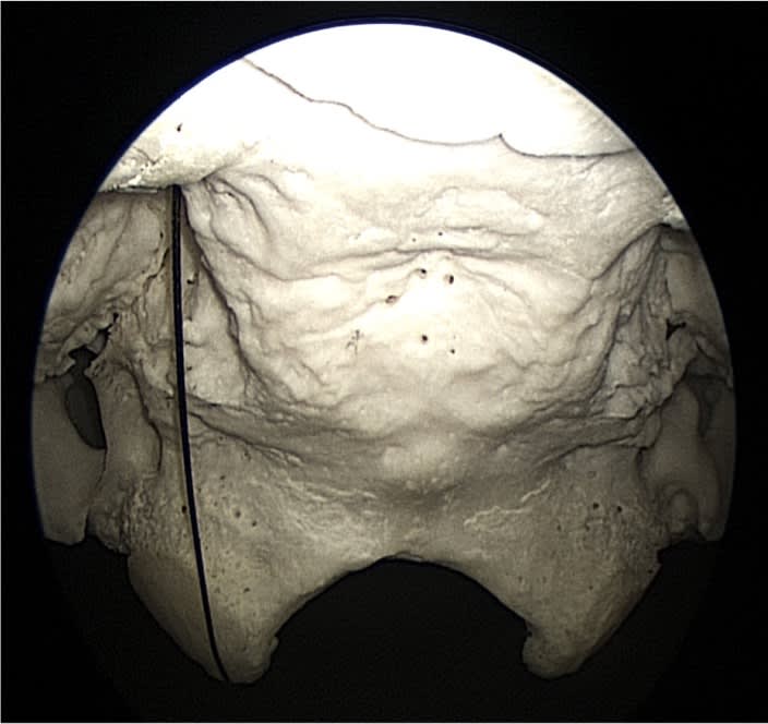 Ventral Skull Base during Medial Condylectomy | Neuroanatomy | The ...