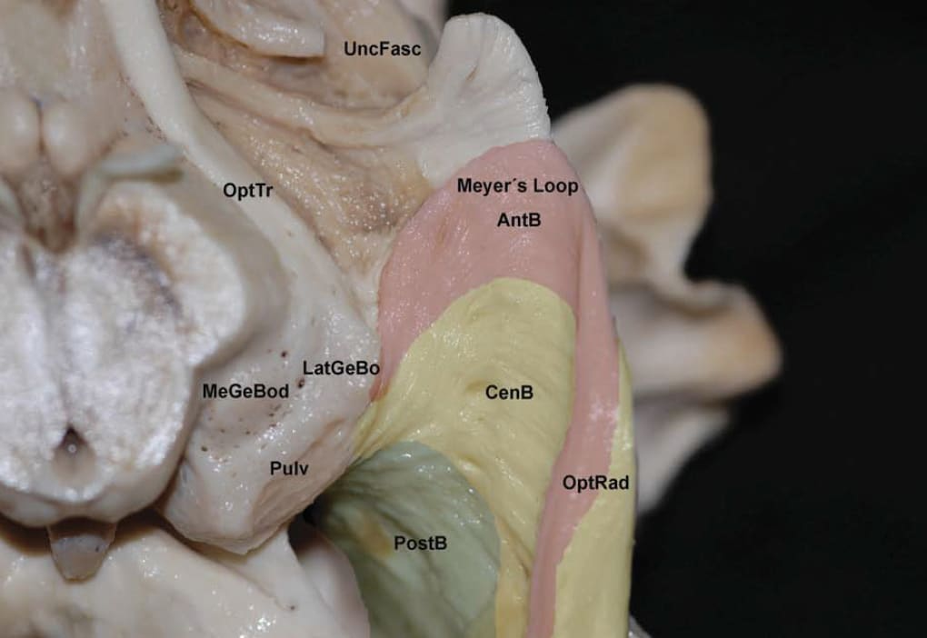 View of the Roof of the Left Temporal Horn | Neuroanatomy | The ...