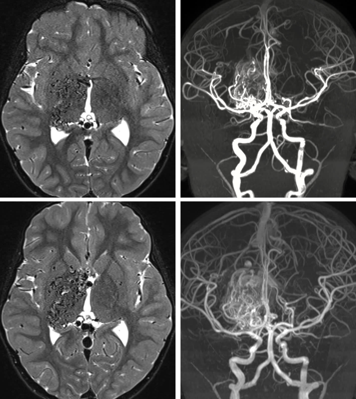 Pediatric AVMs | Cohen Collection | Volumes | The Neurosurgical Atlas