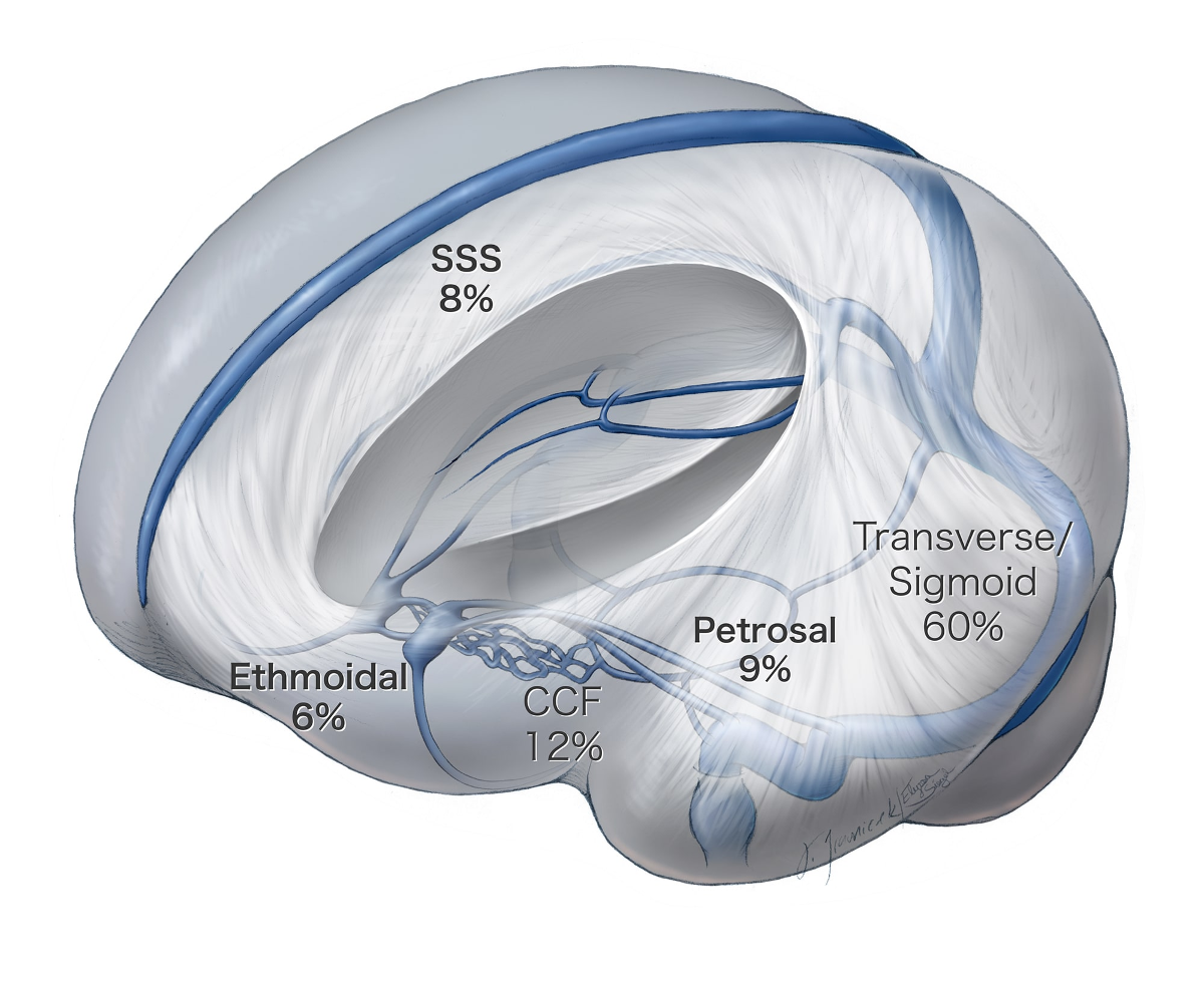 Principles of Dural Arteriovenous Fistula Surgery | Cohen Collection ...