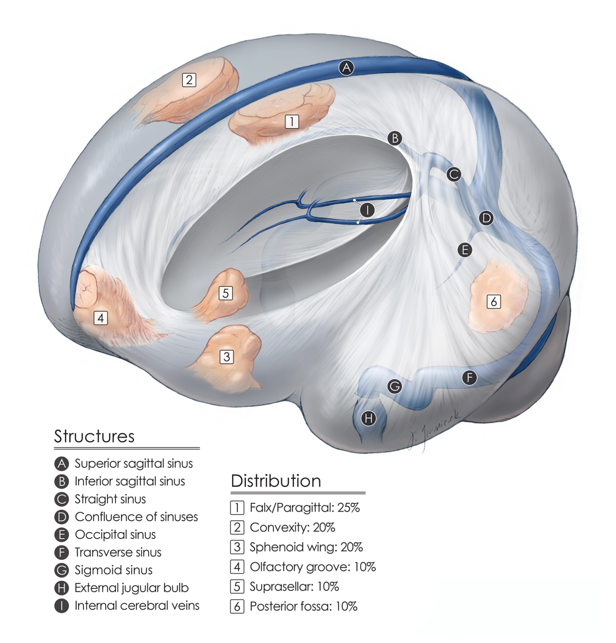 Tuberculum Sella Meningioma | Cohen Collection | Volumes | The ...