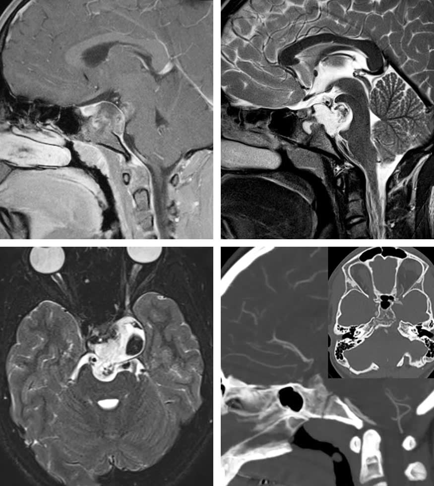 Chordoma and Chondrosarcoma | Cohen Collection | Volumes | The ...