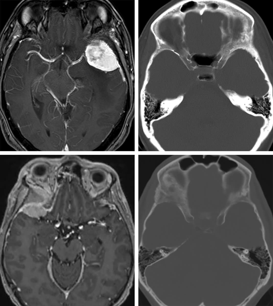 Lateral and Middle Sphenoid Wing Meningioma | Cohen Collection ...