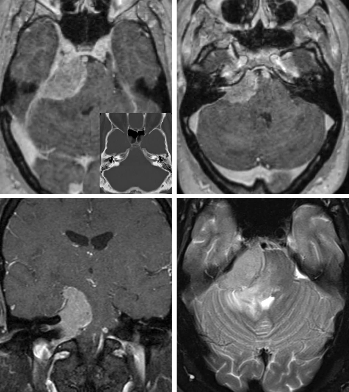 Petroclival Meningioma: Posterior Petrosal Approach | Cohen Collection ...