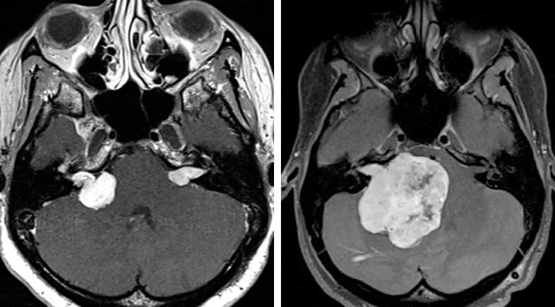 Surgery for Acoustic Neuroma: Retrosigmoid Approach | Cohen Collection ...