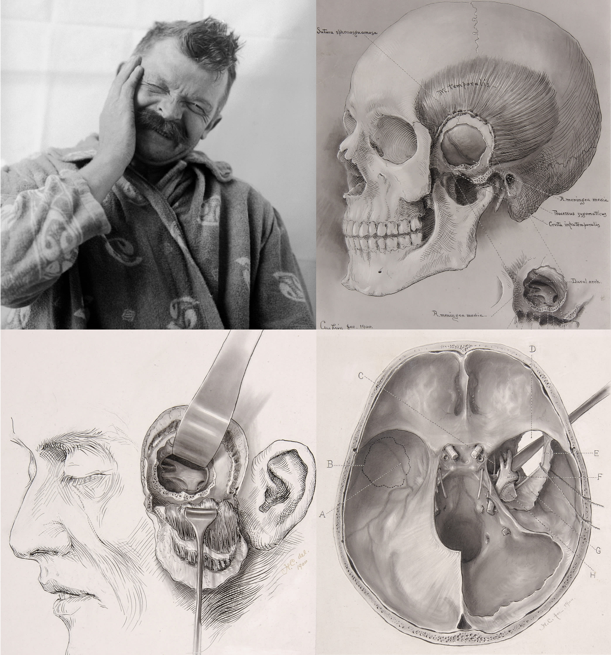Microvascular Decompression for Trigeminal Neuralgia | Cohen Collection ...
