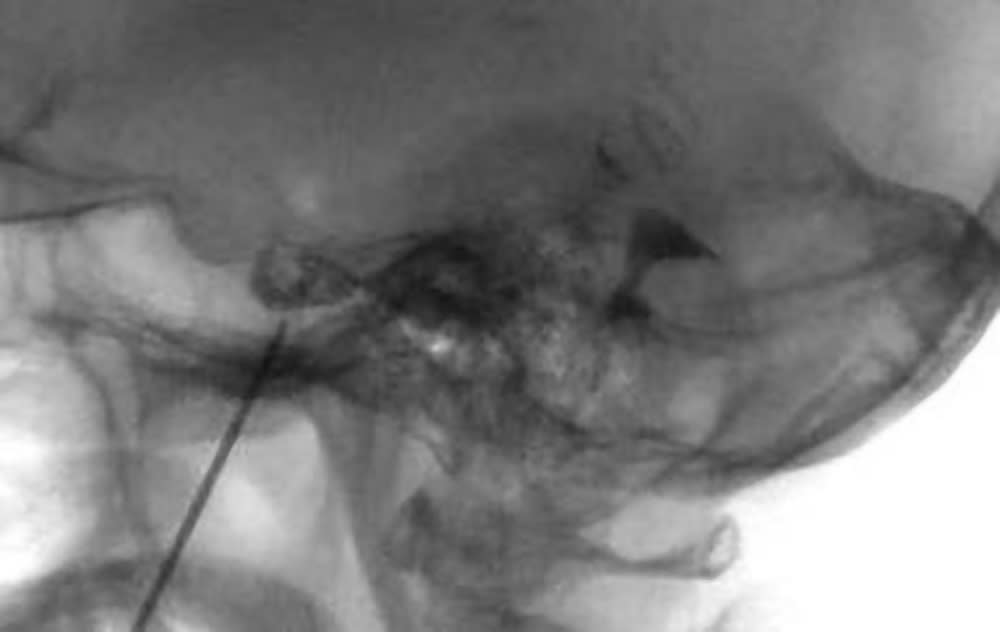 Glycerol Rhizotomy | Cohen Collection | Volumes | The Neurosurgical Atlas