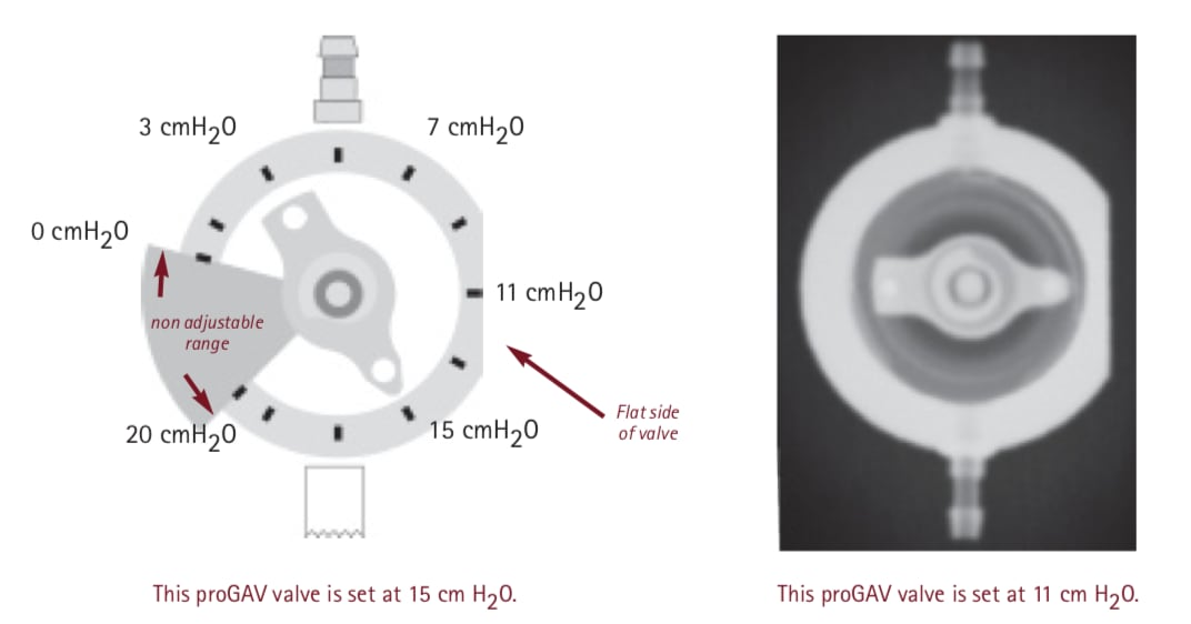 Ventricular Shunt Reference | Cohen Collection | Volumes | The ...