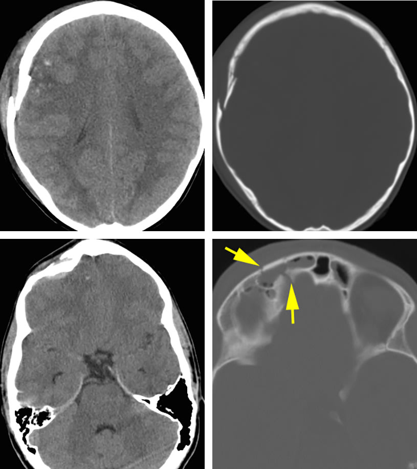 Open Skull Fracture | Cohen Collection | Volumes | The Neurosurgical Atlas