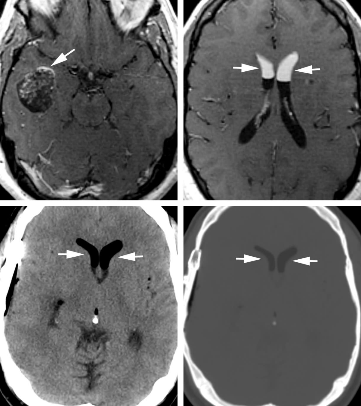 Dermoid Cyst | Cohen Collection | Volumes | The Neurosurgical Atlas