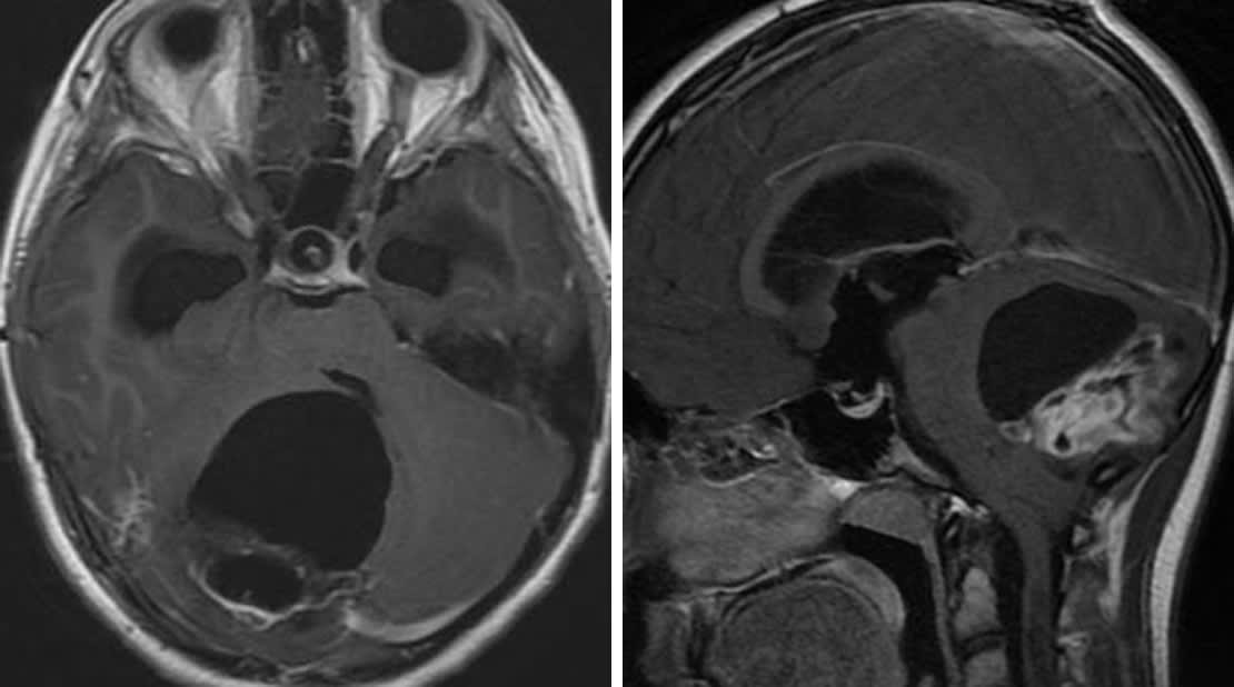 Pilocytic Astrocytoma | Cohen Collection | Volumes | The Neurosurgical ...