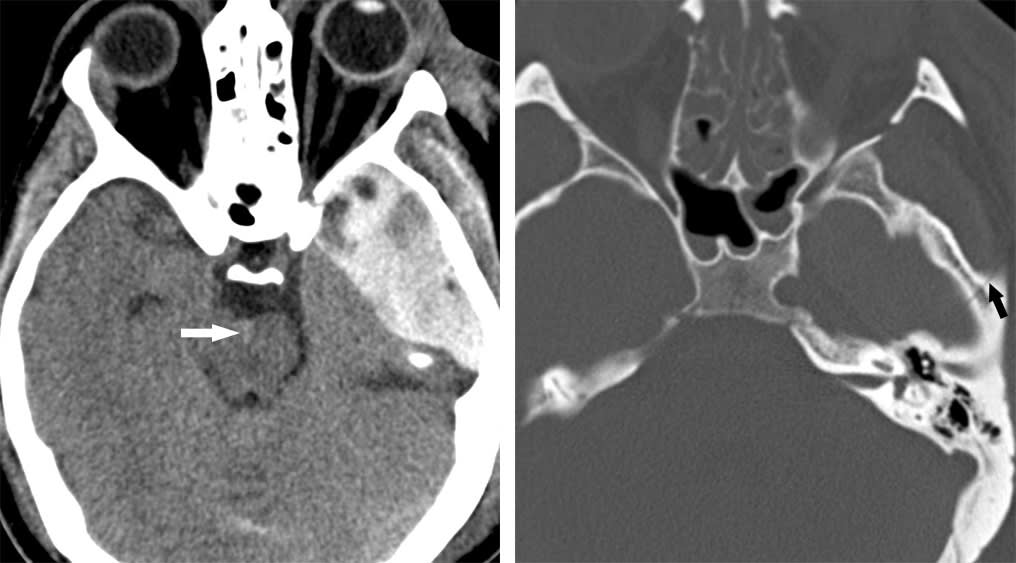 Epidural Hematoma (EDH) | Cohen Collection | Volumes | The ...