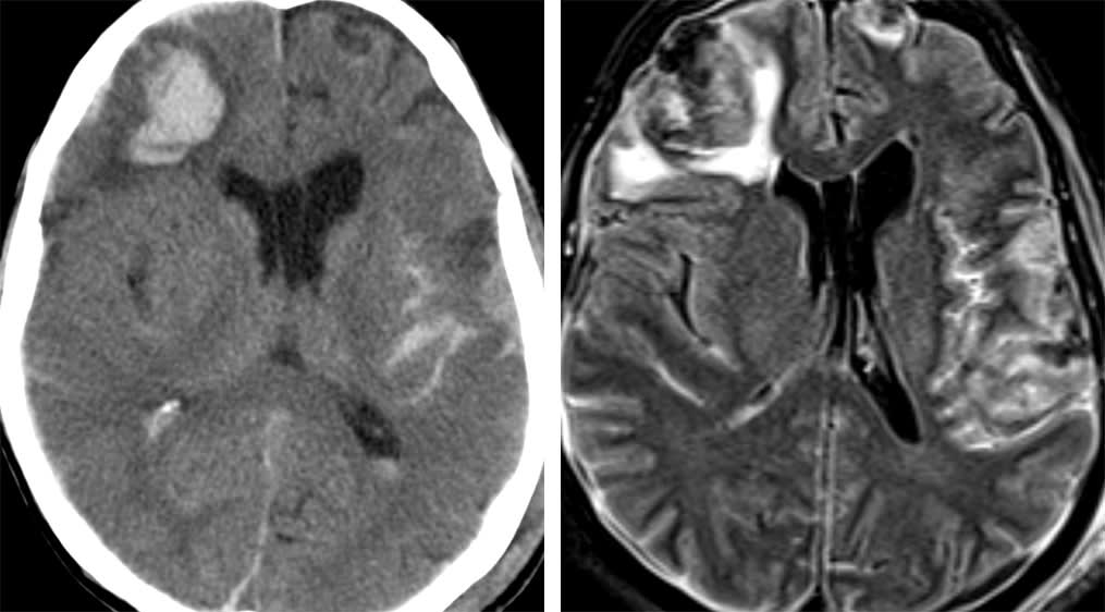 Traumatic Subarachnoid Hemorrhage (tSAH) | Cohen Collection | Volumes ...