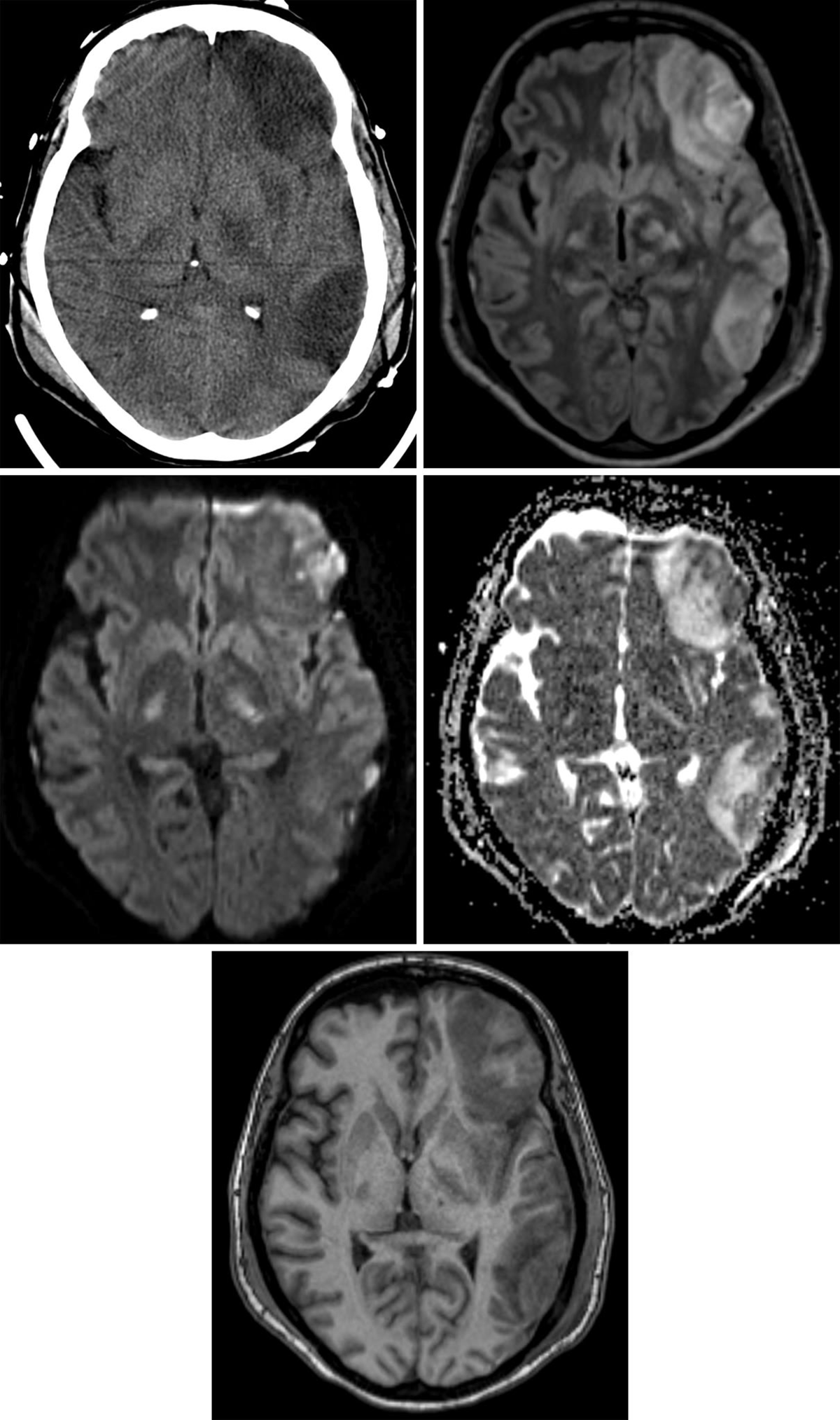 Cerebral Edema | Cohen Collection | Volumes | The Neurosurgical Atlas