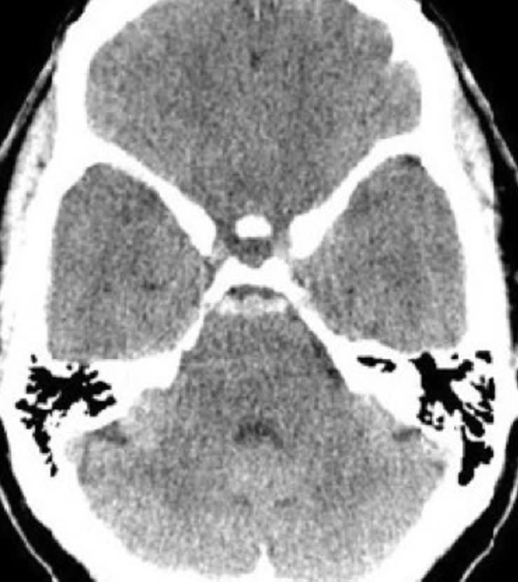 Imaging Evaluation of SAH and Aneurysm | Cohen Collection | Volumes ...