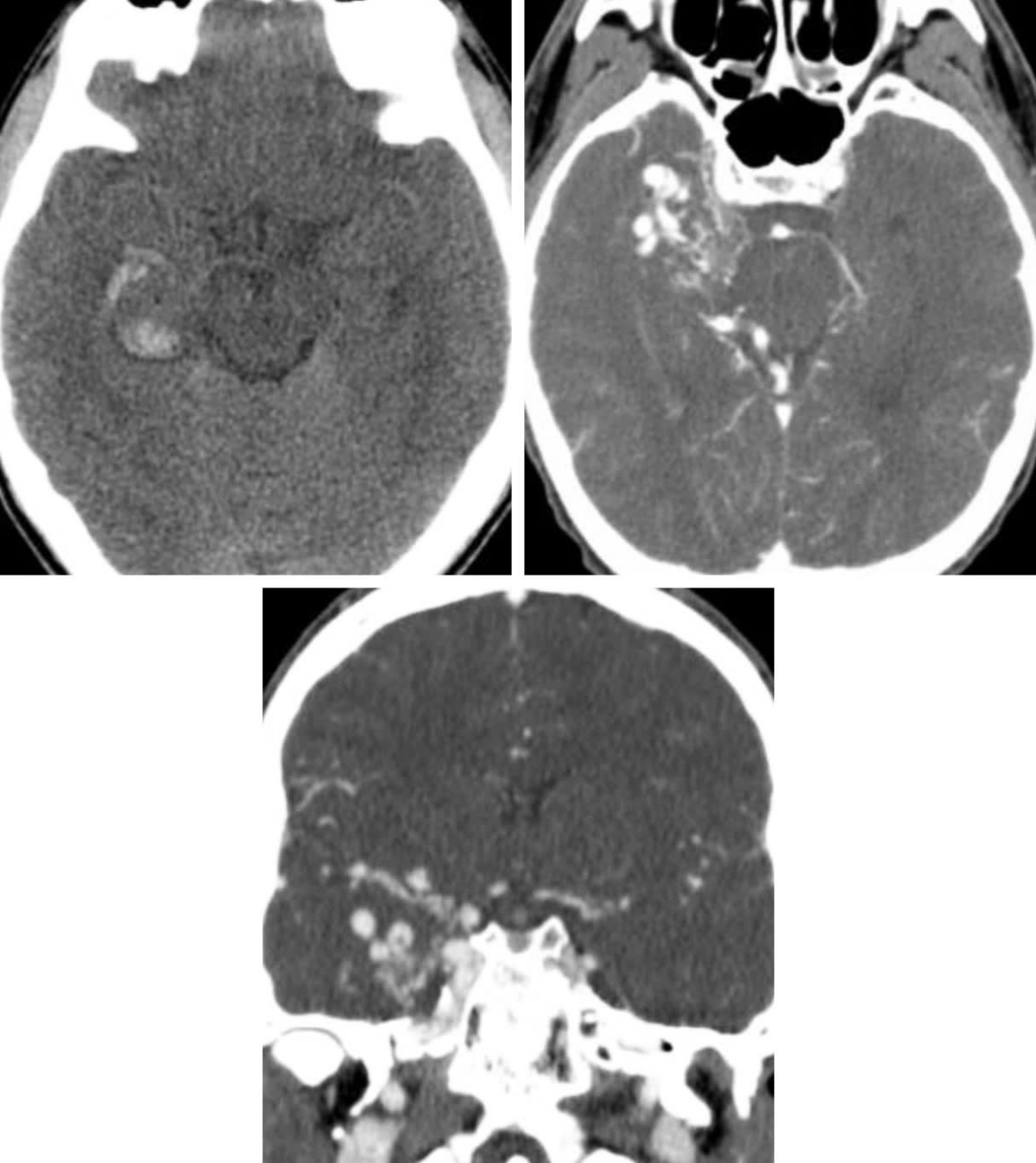 Arteriovenous Malformation | Cohen Collection | Volumes | The ...