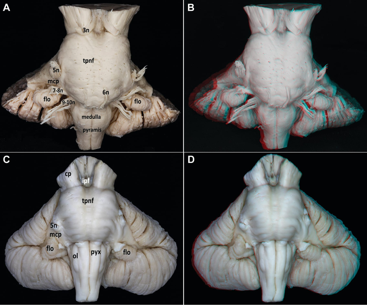 3D Simulation of Fiber Dissection of the Cerebellum and Brainstem ...