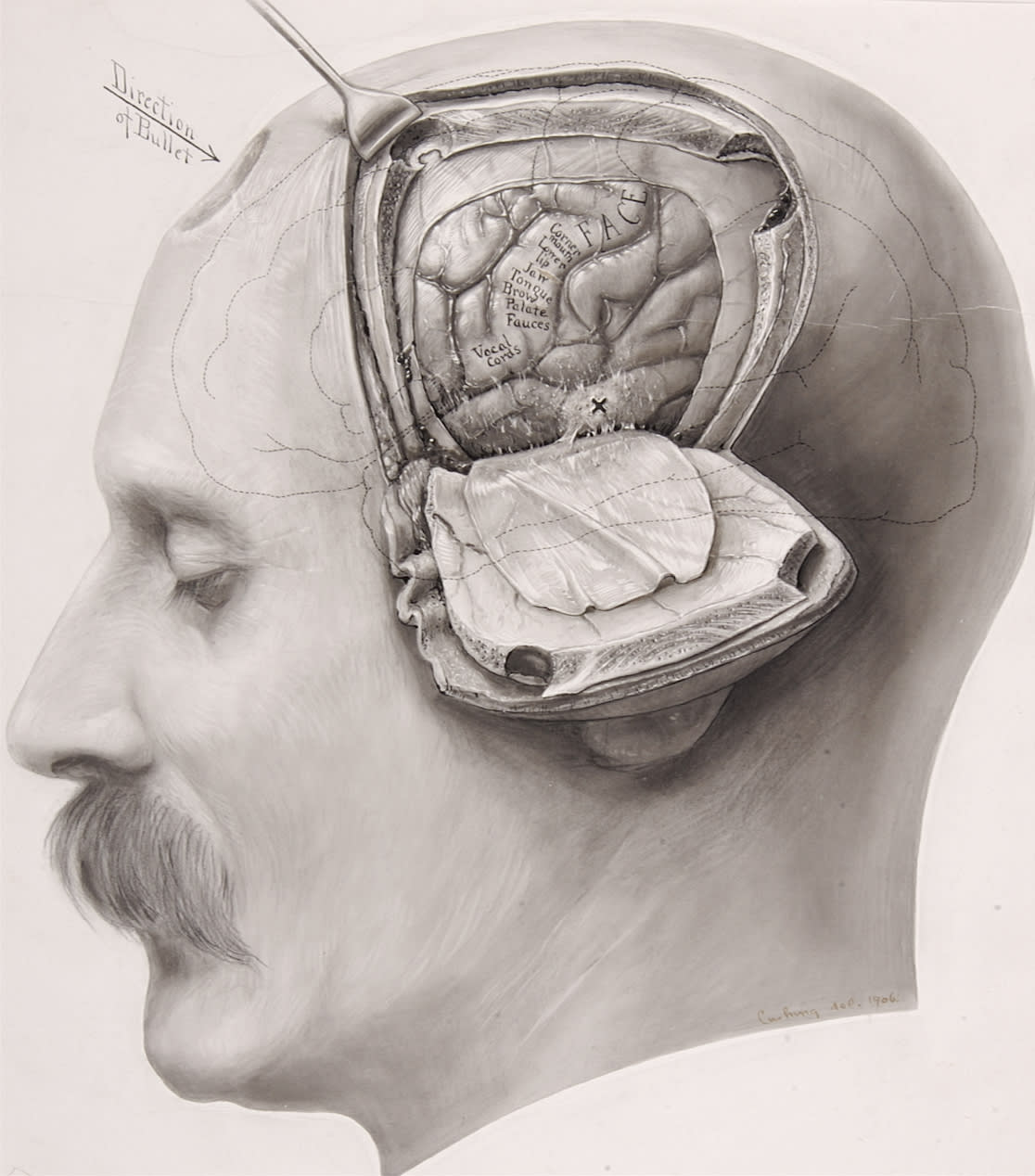 Burr Holes and Bone Flaps | Cohen Collection | Volumes | The ...